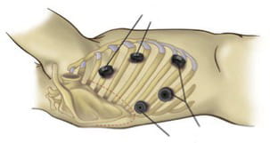 Esophageal Surgery | Thoracic & Esophageal Surgery| For Clinicians ...