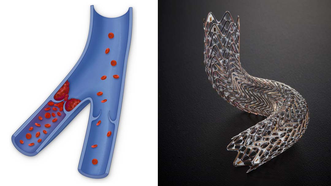 GORE VBX Study | Heart & Vascular Clinical Research and Trials ...