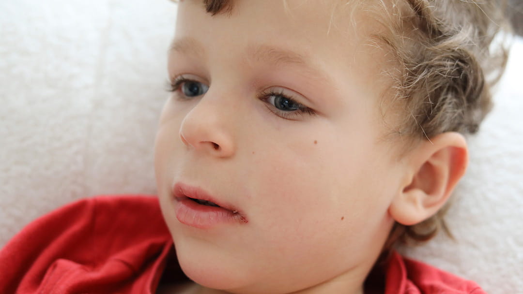 3 Common Childhood Skin Conditions No One Talks About | University ...