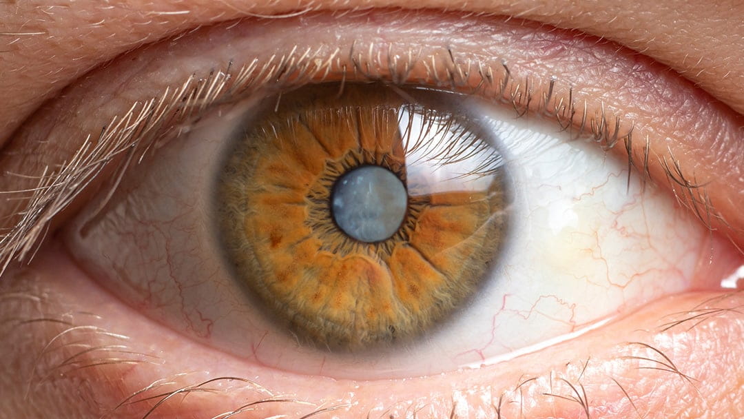 Inherited Eye Diseases: The Importance of Early Diagnosis | University ...