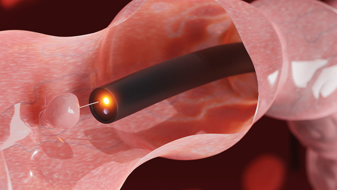 Colon Cancer Screening Options: What's Right For You? | University ...