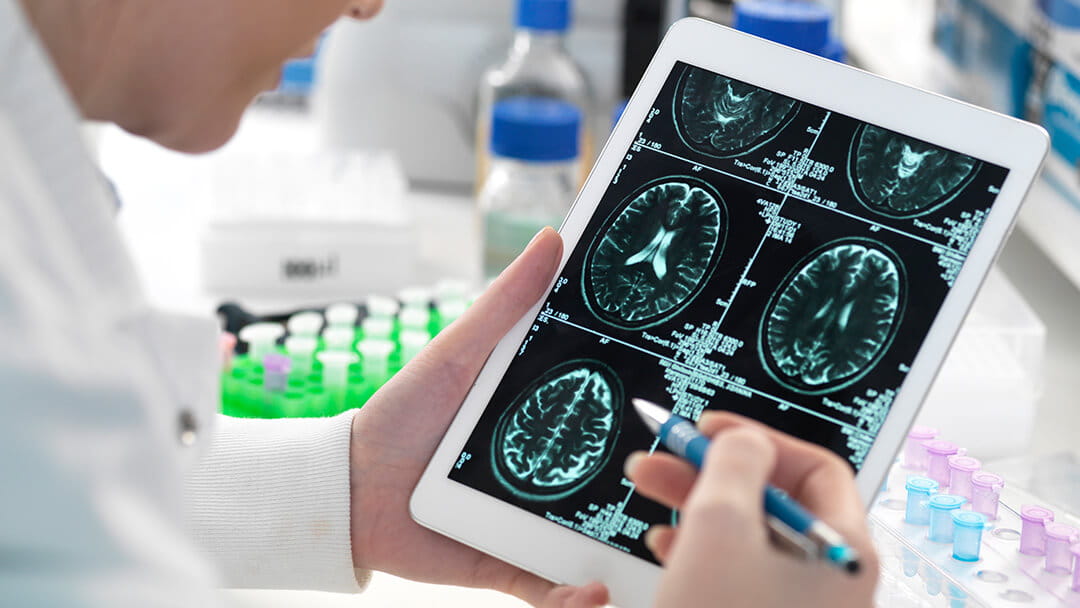 New Research Holds Promise for Alzheimer’s Disease | University Hospitals