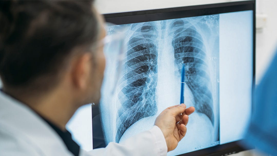 Popcorn Lung: A Dangerous Risk of Vaping | University Hospitals