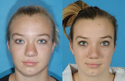 Cleft Rhinoplasty Photo Gallery | Division of Pediatric Plastic ...