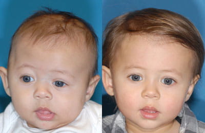 Cranial Vault Remodeling Photo Gallery | Division of Pediatric Plastic ...