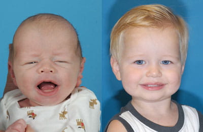 Craniosynostosis Photo Gallery | Division of Pediatric Plastic ...
