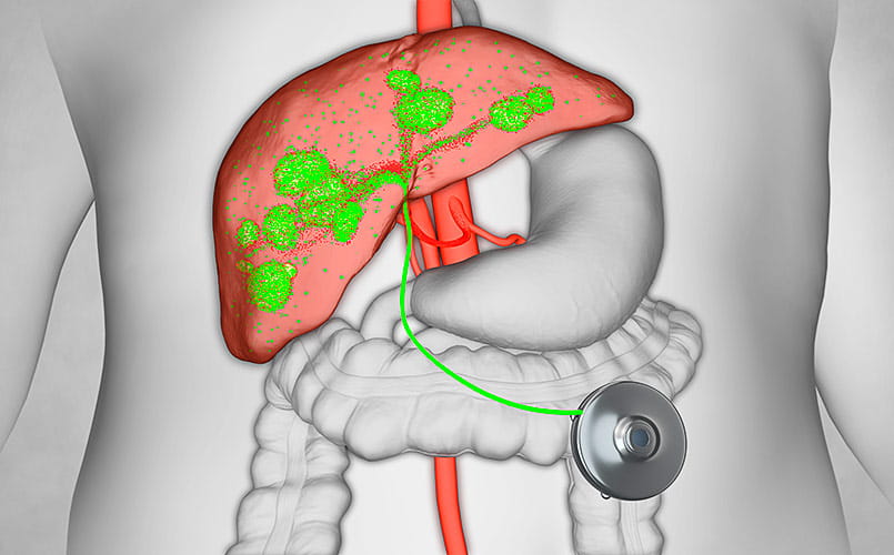 Hepatic Artery Infusion (HAI) Therapy | University Hospitals ...