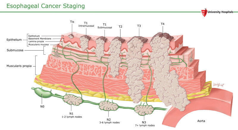 Team Approach to Esophageal Cancer Treatment in Cleveland, OH ...