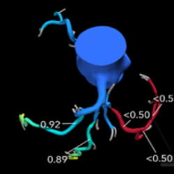 Coronary Computed Tomography Angiography and HeartFlow Analysis ...