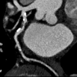 Coronary Computed Tomography Angiography and HeartFlow Analysis ...