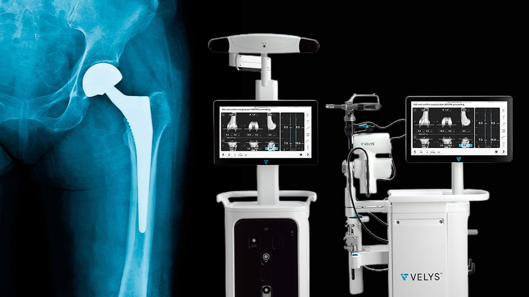 Advanced Computer-assisted Technology for Hip Replacement and How It ...