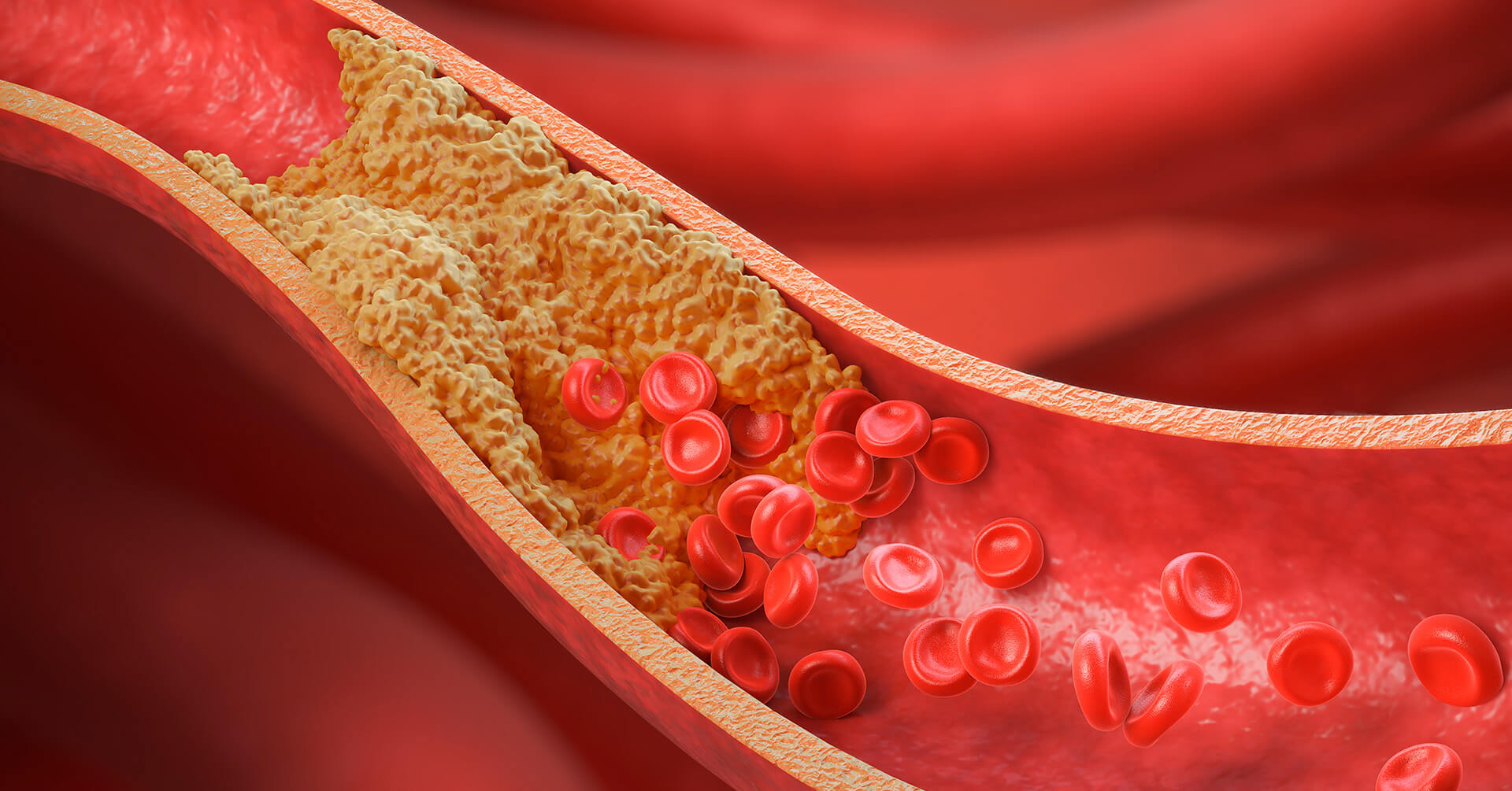The Role of Coronary Artery Calcium in Cardiometabolic Health ...