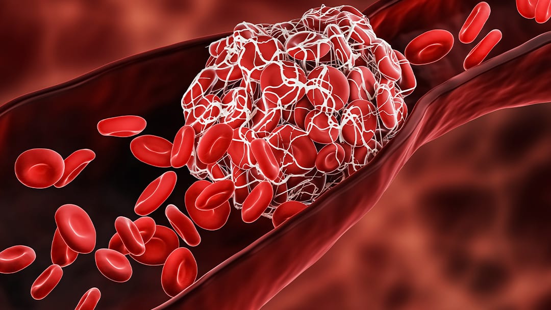 Preventing Deep Vein Thrombosis from Coming Back | University Hospitals