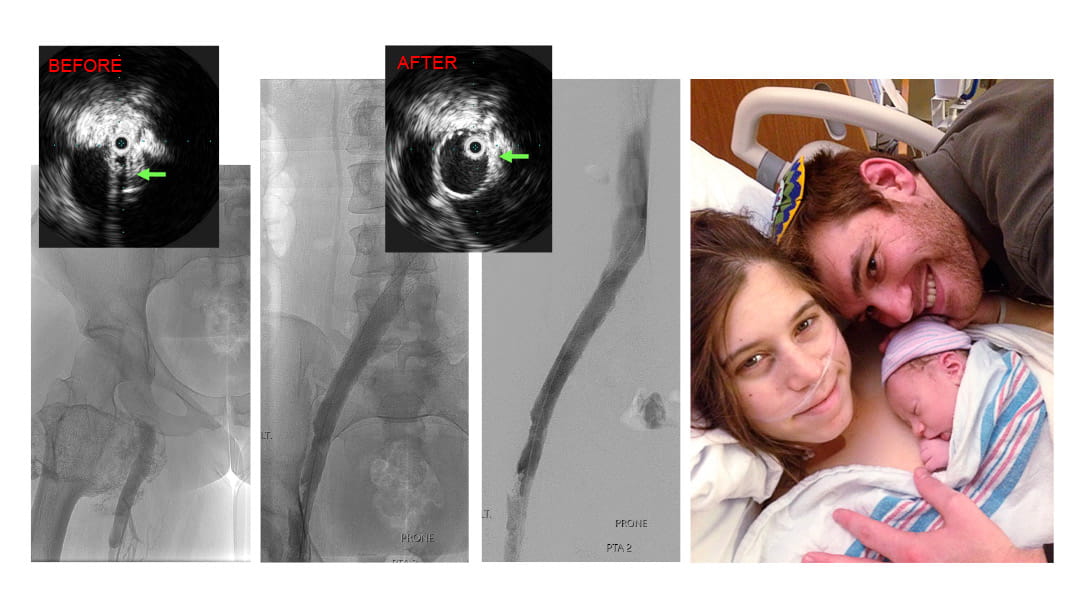 Pregnancy Reveals Serious Vascular Condition for Mother | University ...