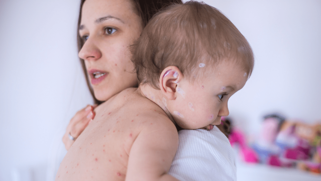 5 Things You Need to Know About Measles | University Hospitals